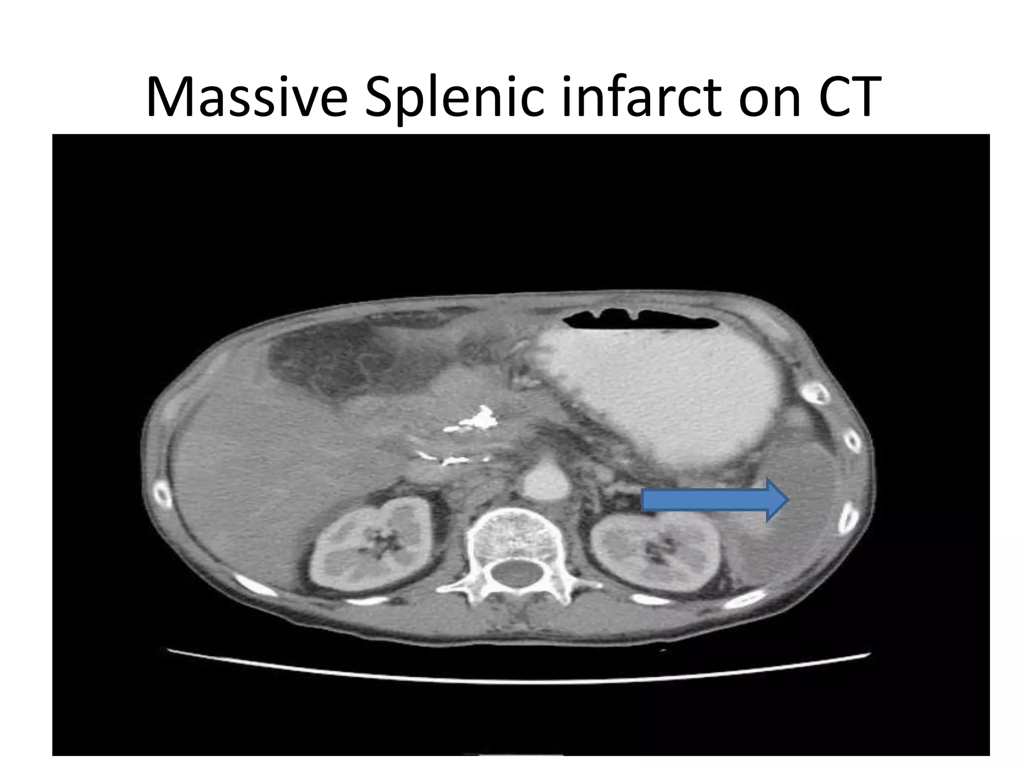Spleen Radiology | PPTX