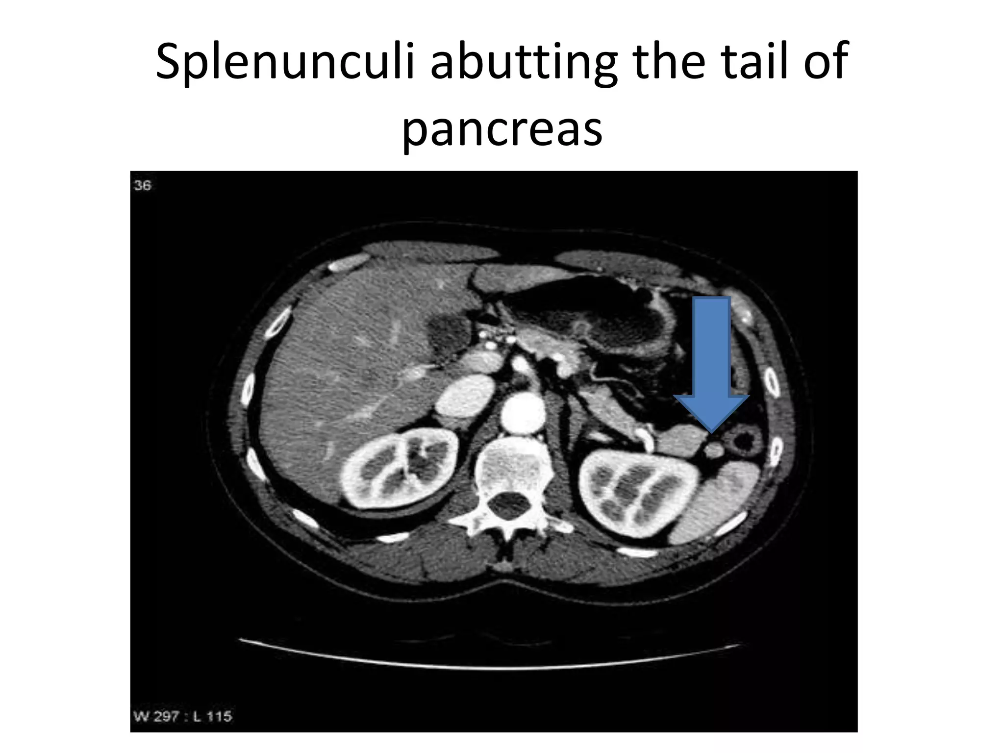 Spleen Radiology | PPTX