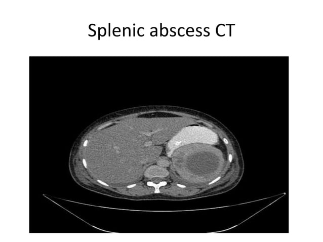 Spleen Radiology | PPTX