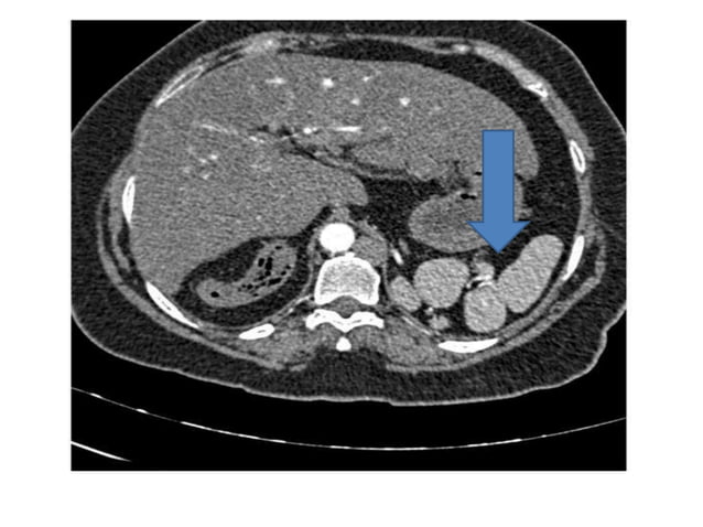 Spleen Radiology | PPTX