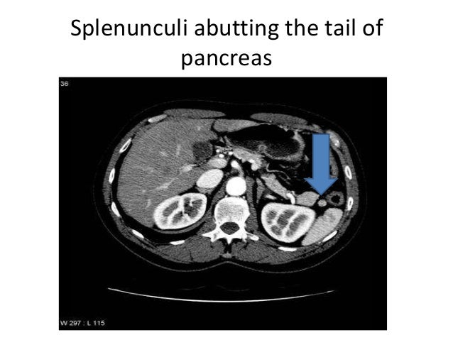 Splenorenal Ligament Tail Of Pancreas