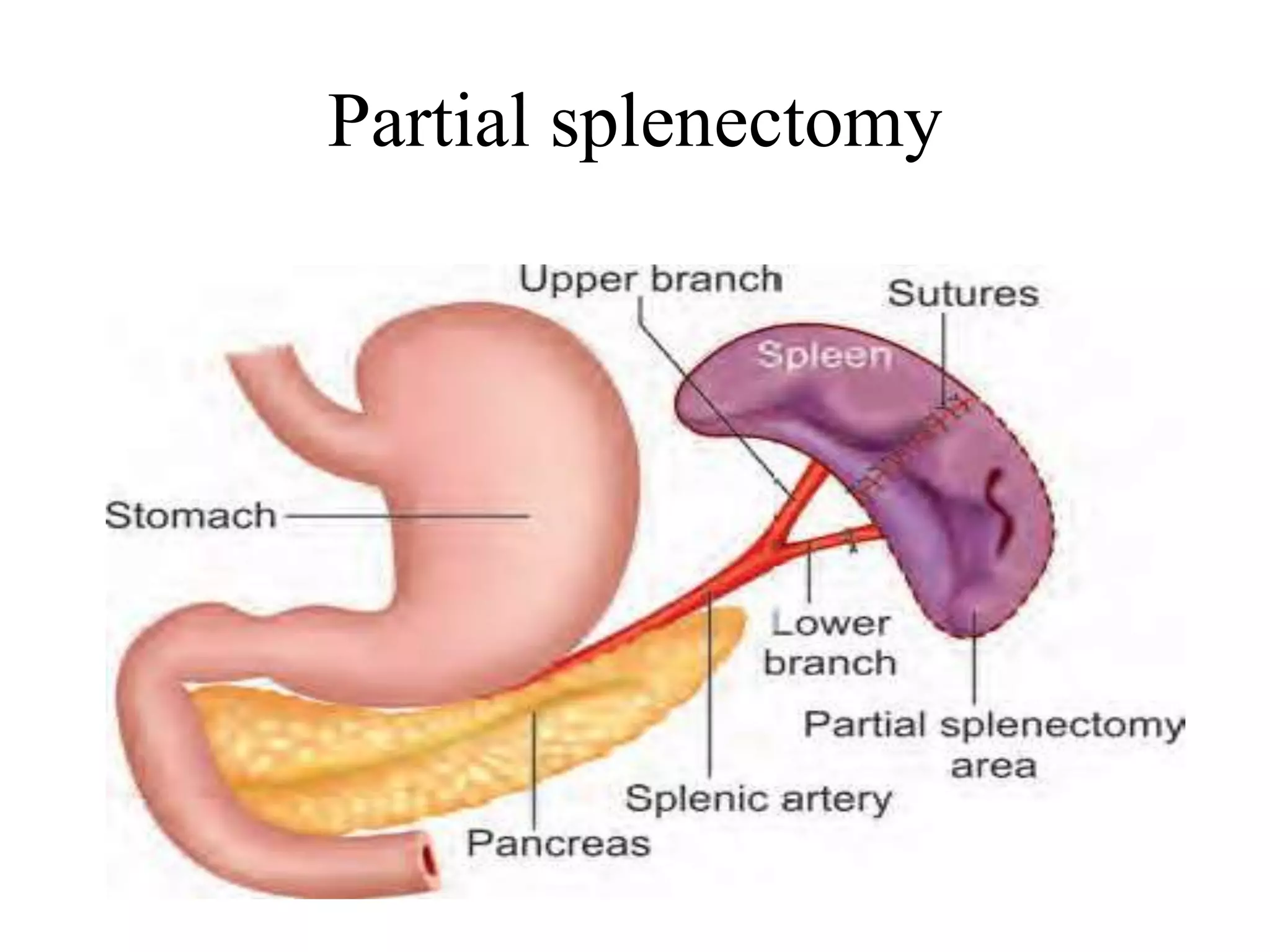 splenic injury | PPTX