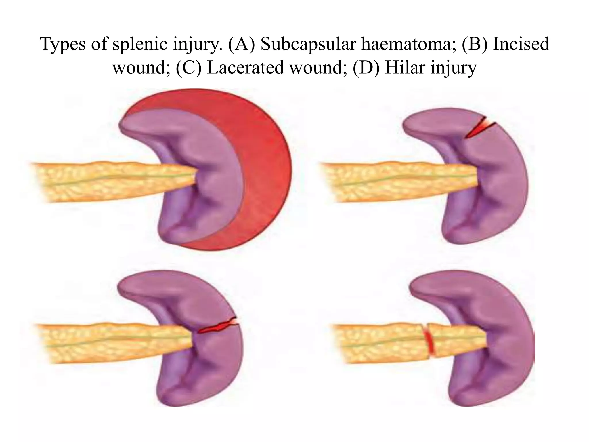 splenic injury | PPTX