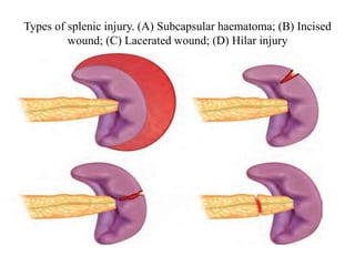 splenic injury | PPTX