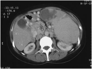 spleen power point by doctor ahmed .ppt.ppt
