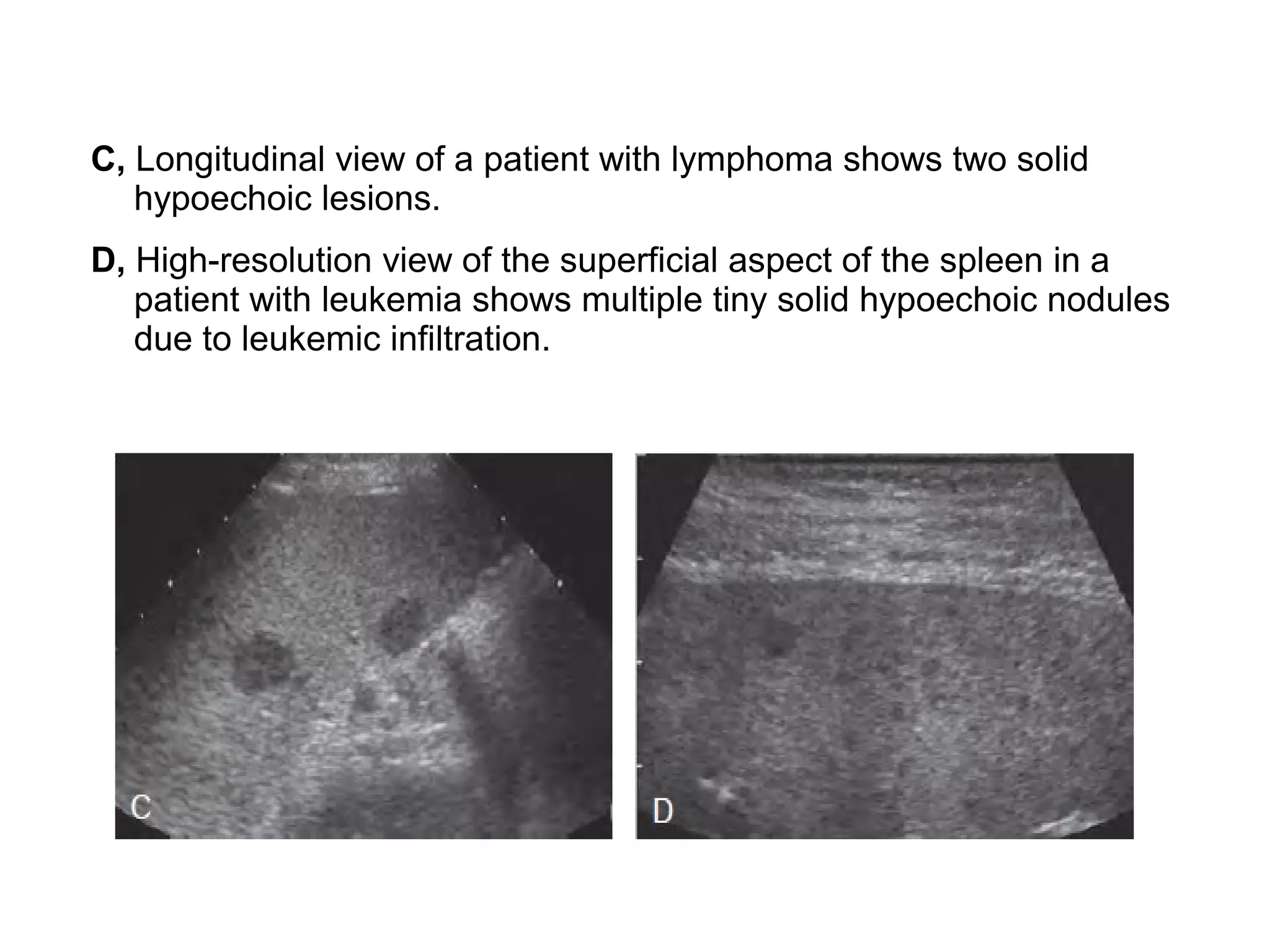 Spleen Ultrasound anatomy structure scanning techniques and pathologies ...