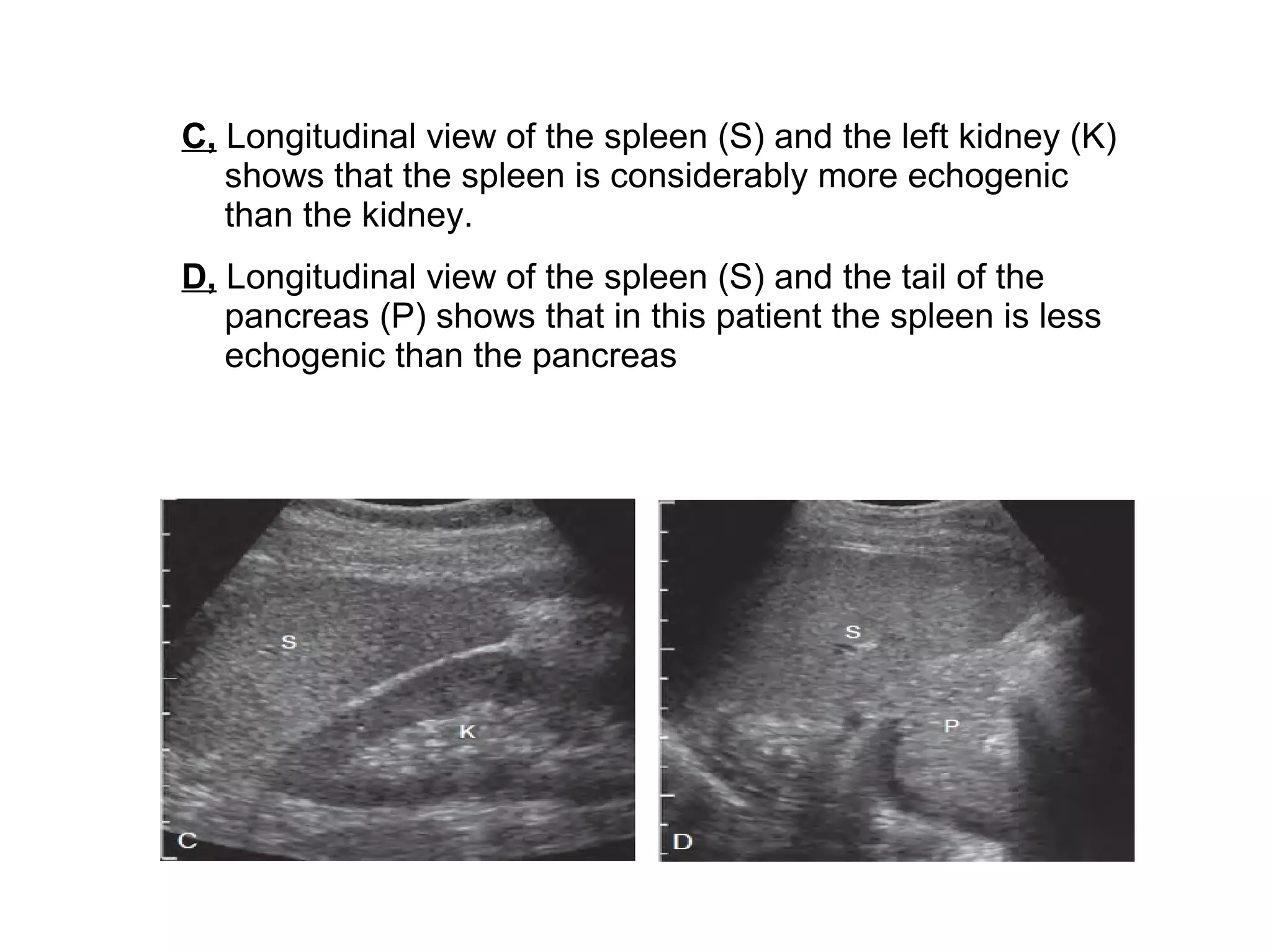 Spleen Ultrasound anatomy structure scanning techniques and pathologies ...