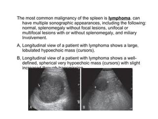 Spleen Ultrasound anatomy structure scanning techniques and pathologies ...