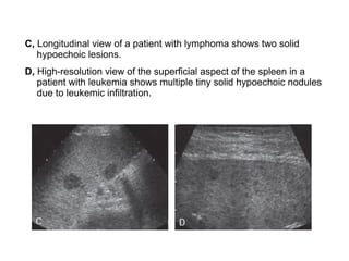 Spleen Ultrasound anatomy structure scanning techniques and pathologies ...