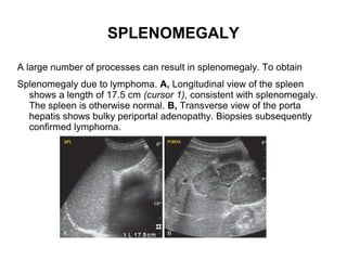 Spleen Ultrasound anatomy structure scanning techniques and pathologies ...