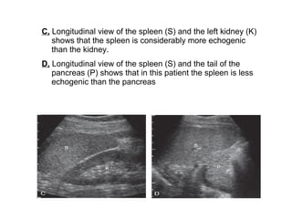 Spleen Ultrasound anatomy structure scanning techniques and pathologies ...