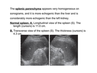 Normal Spleen Ultrasound