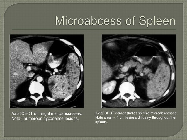 Spleen abcess - CT Findings