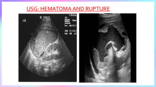 spleen and pancreatic injury grading and management.pdf