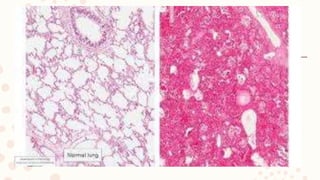 SPLENIC INFARCT, CVC SPLEEN & LUNGS PATHOLOGY PRACTICAL CLASS FOR MBBS ...