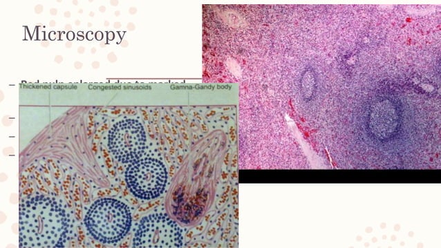 SPLENIC INFARCT, CVC SPLEEN & LUNGS PATHOLOGY PRACTICAL CLASS FOR MBBS ...