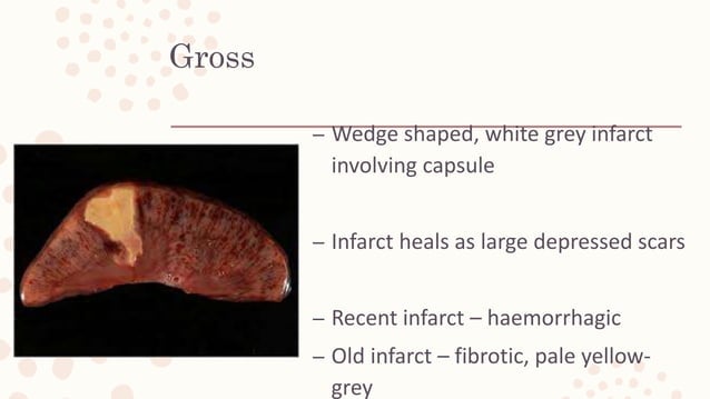 SPLENIC INFARCT, CVC SPLEEN & LUNGS PATHOLOGY PRACTICAL CLASS FOR MBBS