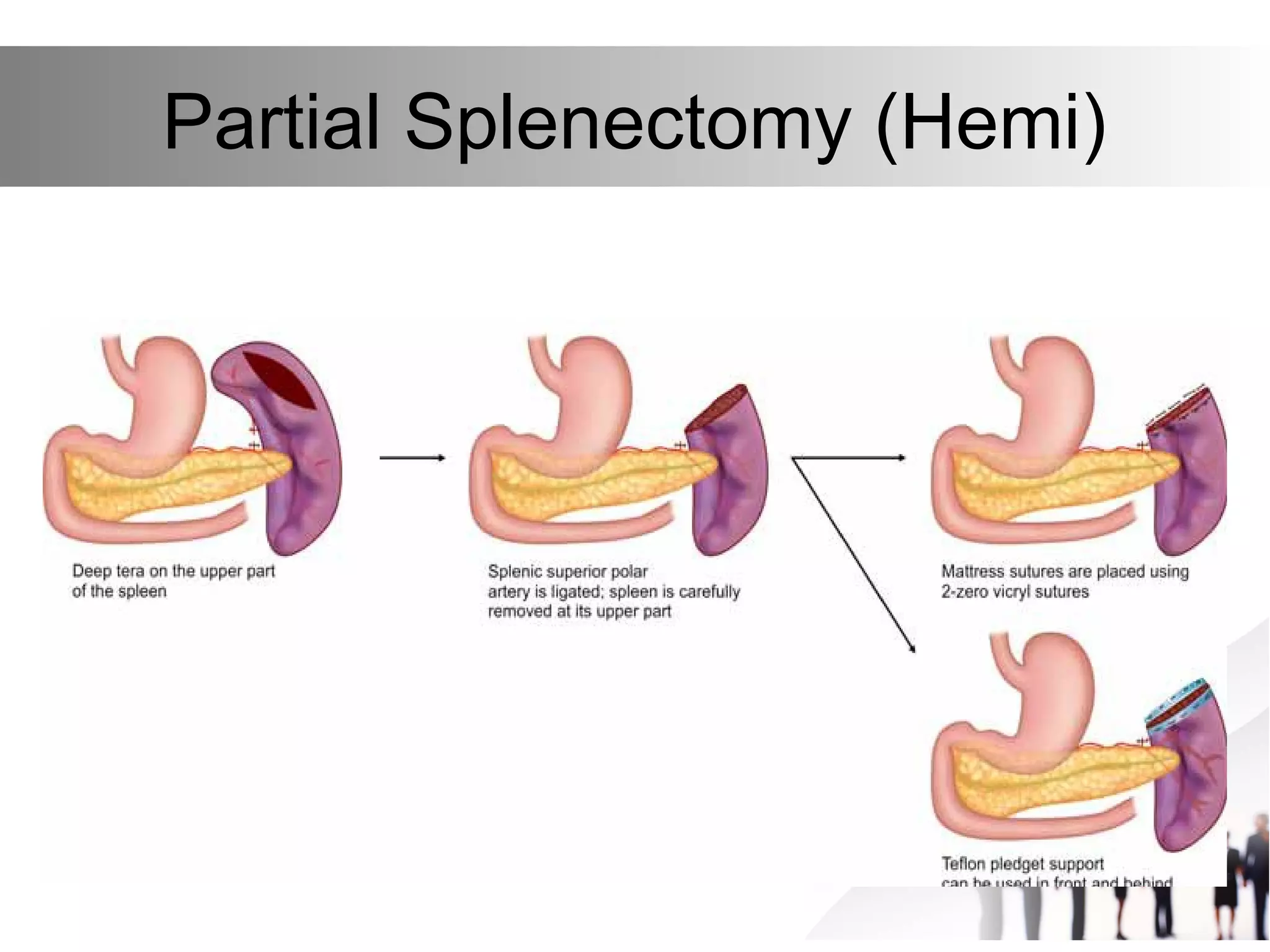 Spleenectomy | PPT