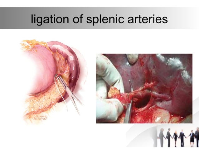 Spleenectomy | PPT