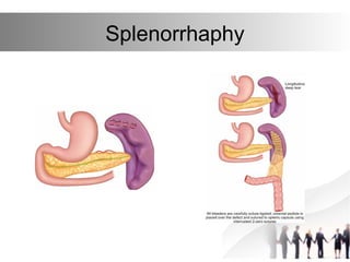 Spleenectomy | PPT