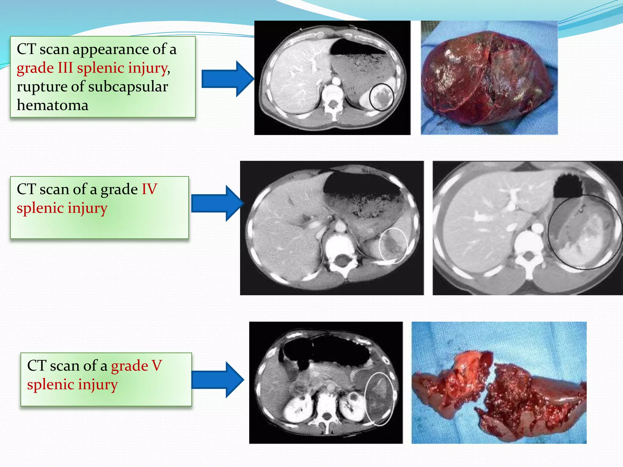 Spleenectomy | PPTX
