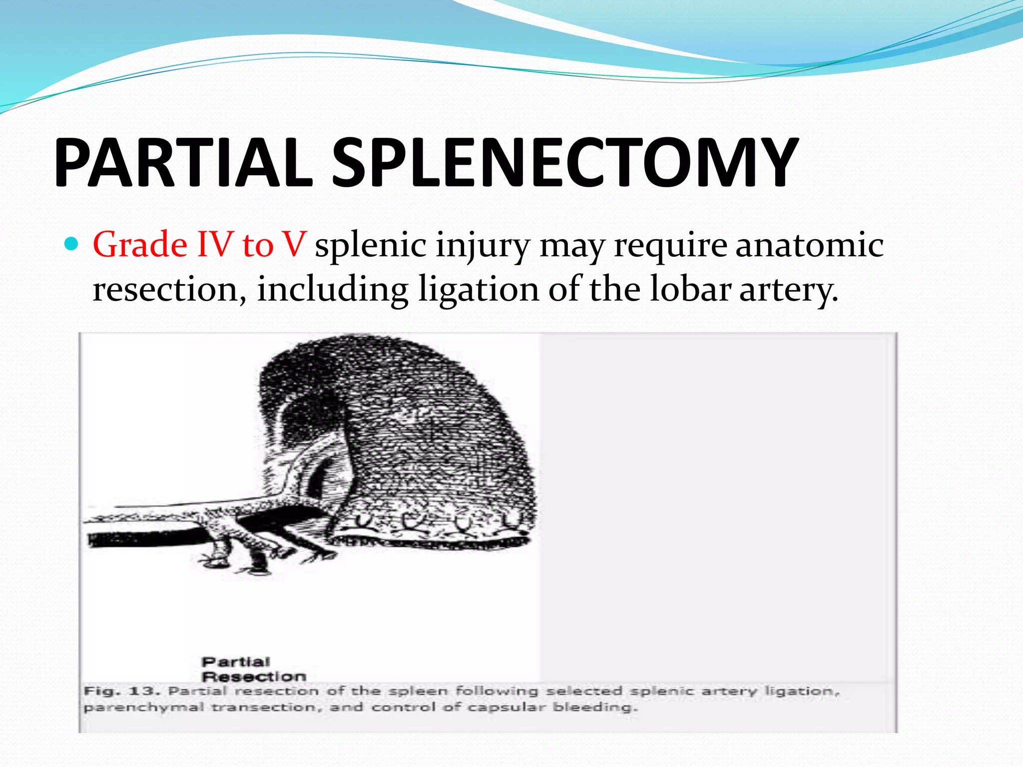 Spleenectomy | PPTX
