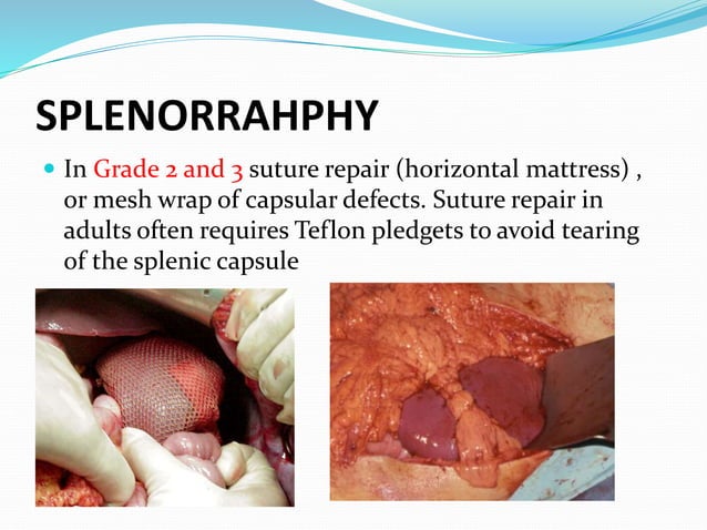 Spleenectomy | PPTX | Death, Injury, or Military Conflict | Sensitive ...