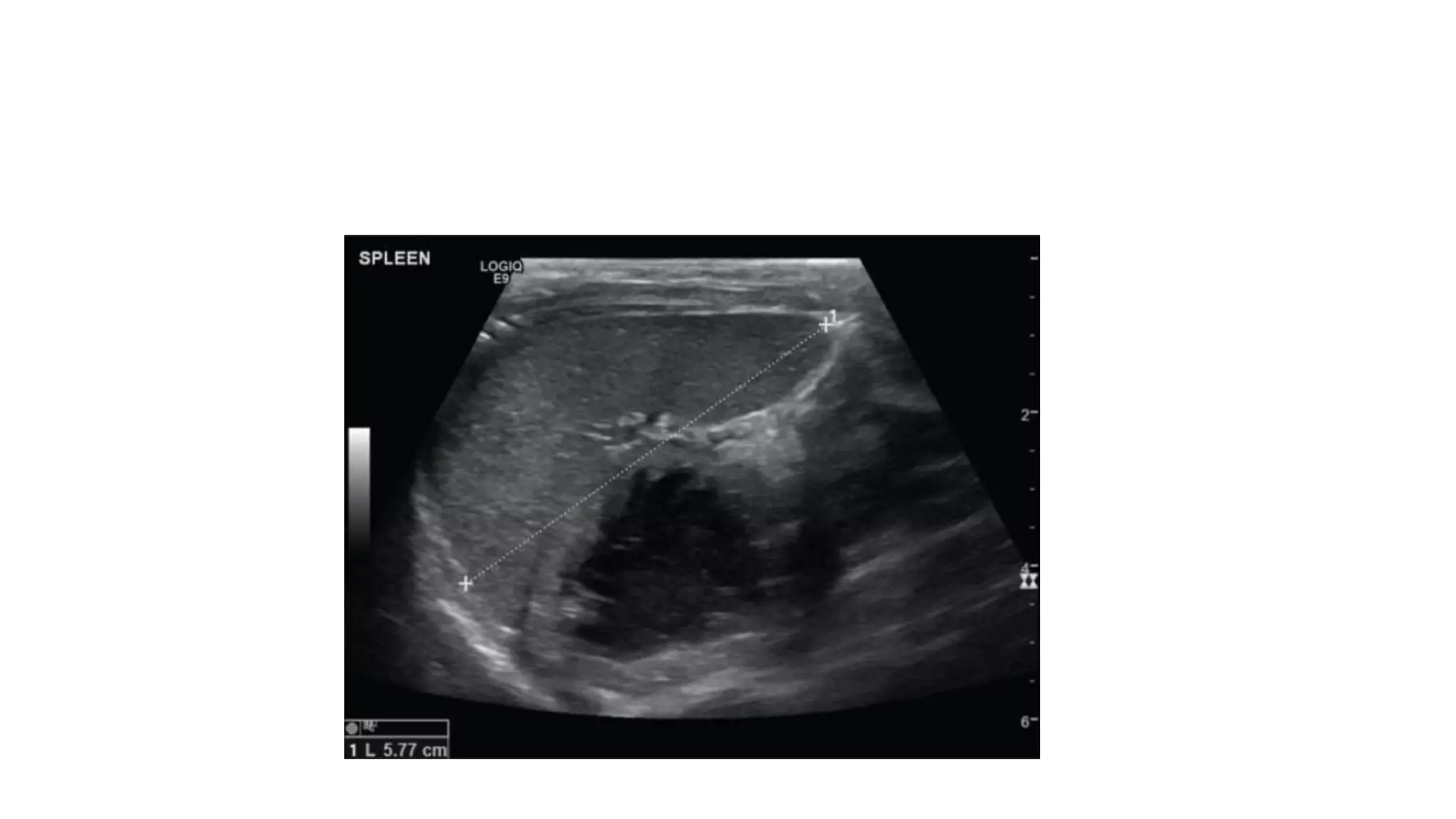spleen size chart.pptx