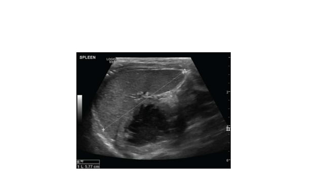 spleen size chart.pptx