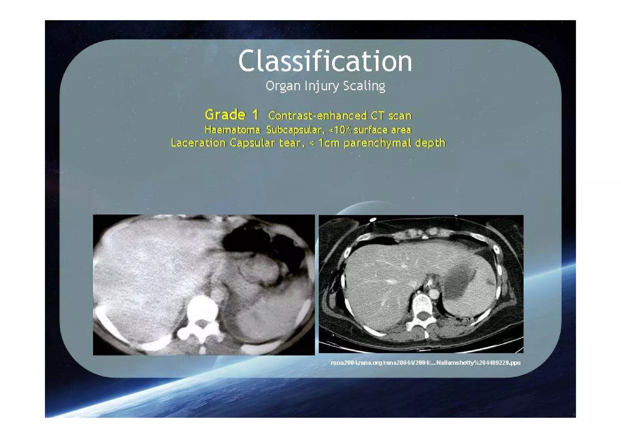 Spleen Trauma Classification | PDF