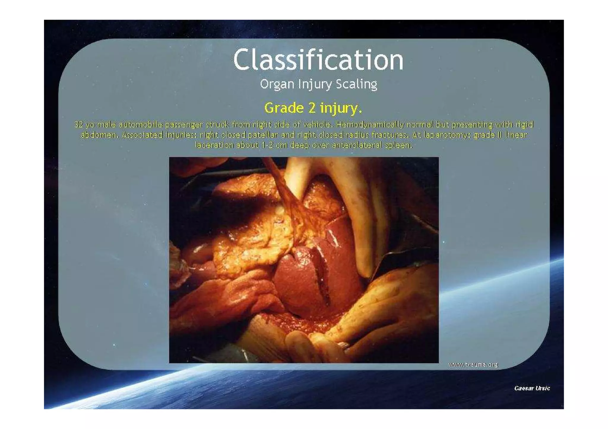 Spleen Trauma Classification | PDF