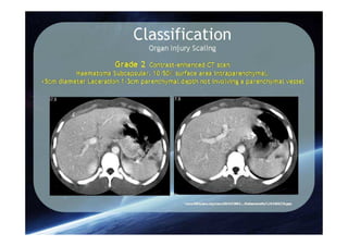 Spleen Trauma Classification | PDF
