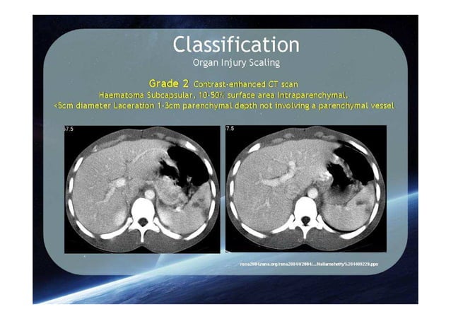 Spleen Trauma Classification | PDF