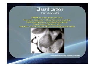 Spleen Trauma Classification | PDF