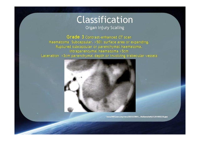 Spleen Trauma Classification | PDF