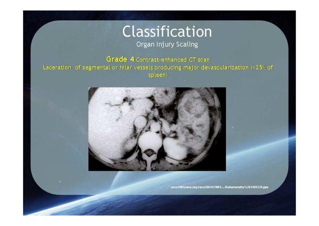 Spleen Trauma Classification | PDF