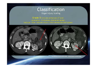 Spleen Trauma Classification | PDF