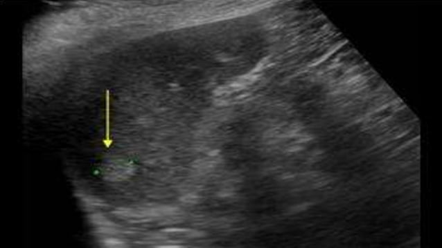Spleen ultrasound | PPT