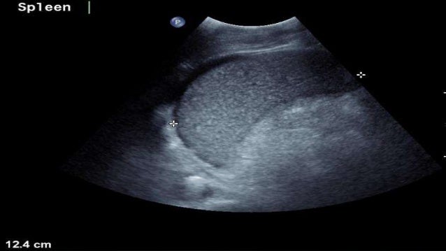 Spleen ultrasound
