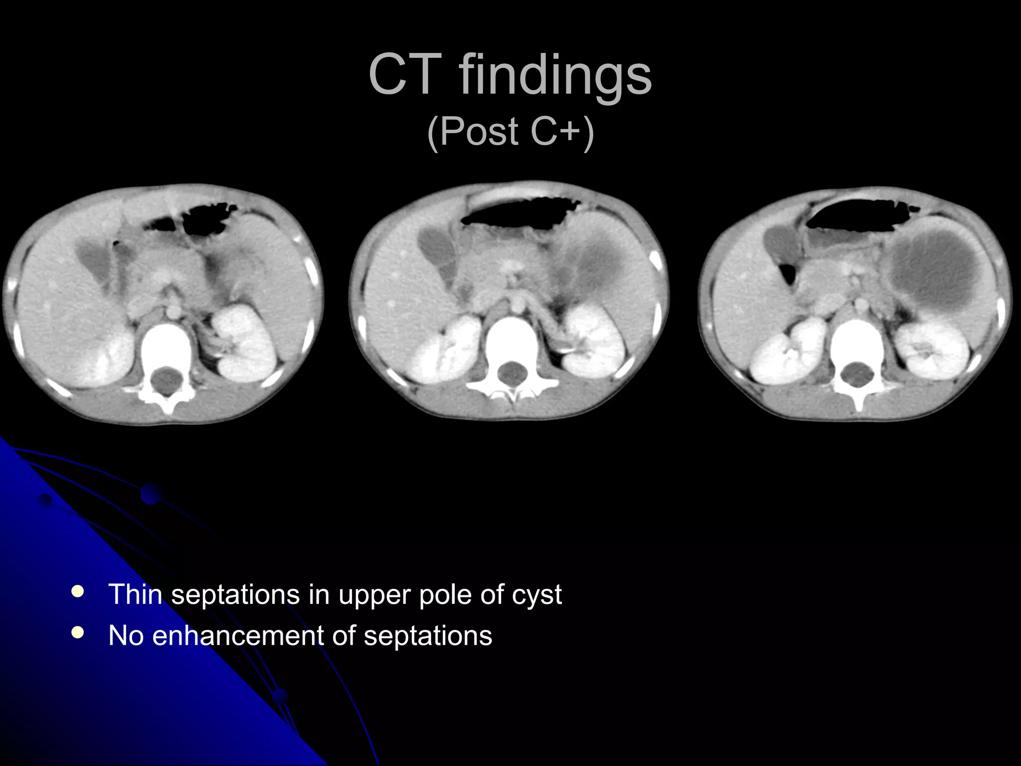 Splenic epidermoid cyst | PPT