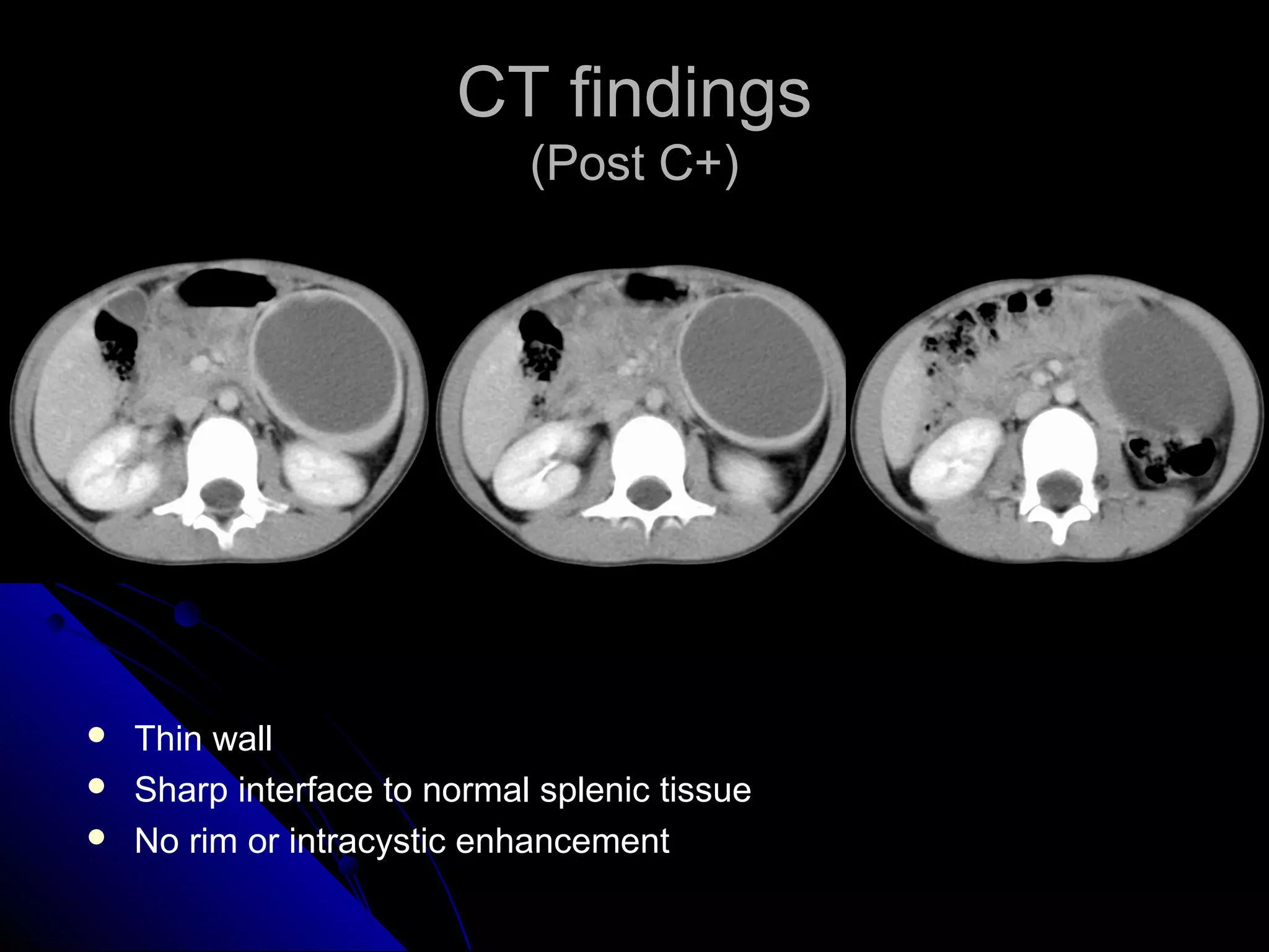 Splenic epidermoid cyst | PPT