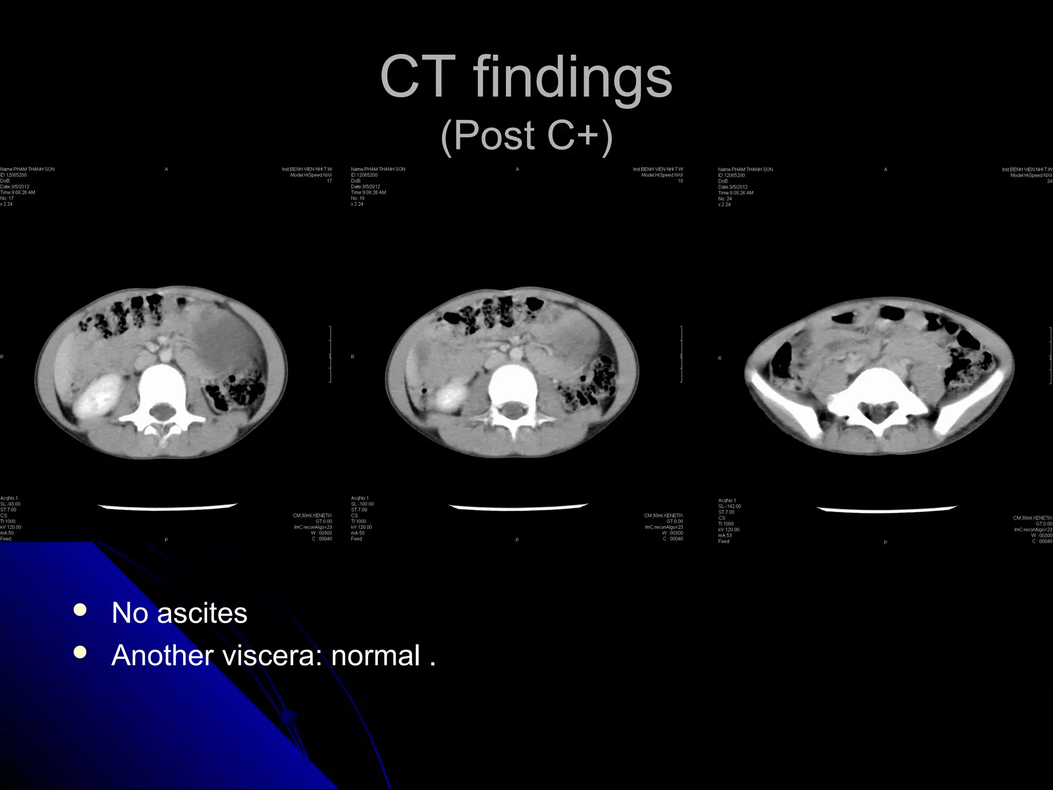 Splenic epidermoid cyst | PPT