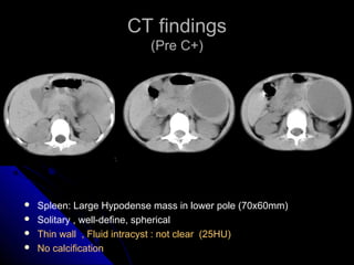 Splenic epidermoid cyst | PPT