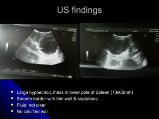 Splenic epidermoid cyst | PPT