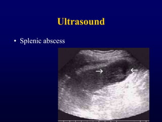 Splenic abscess the lect.ppt