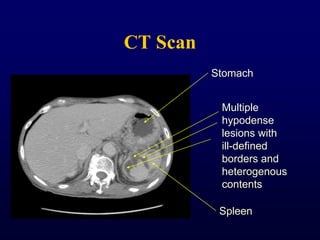 Splenic abscess the lect.ppt