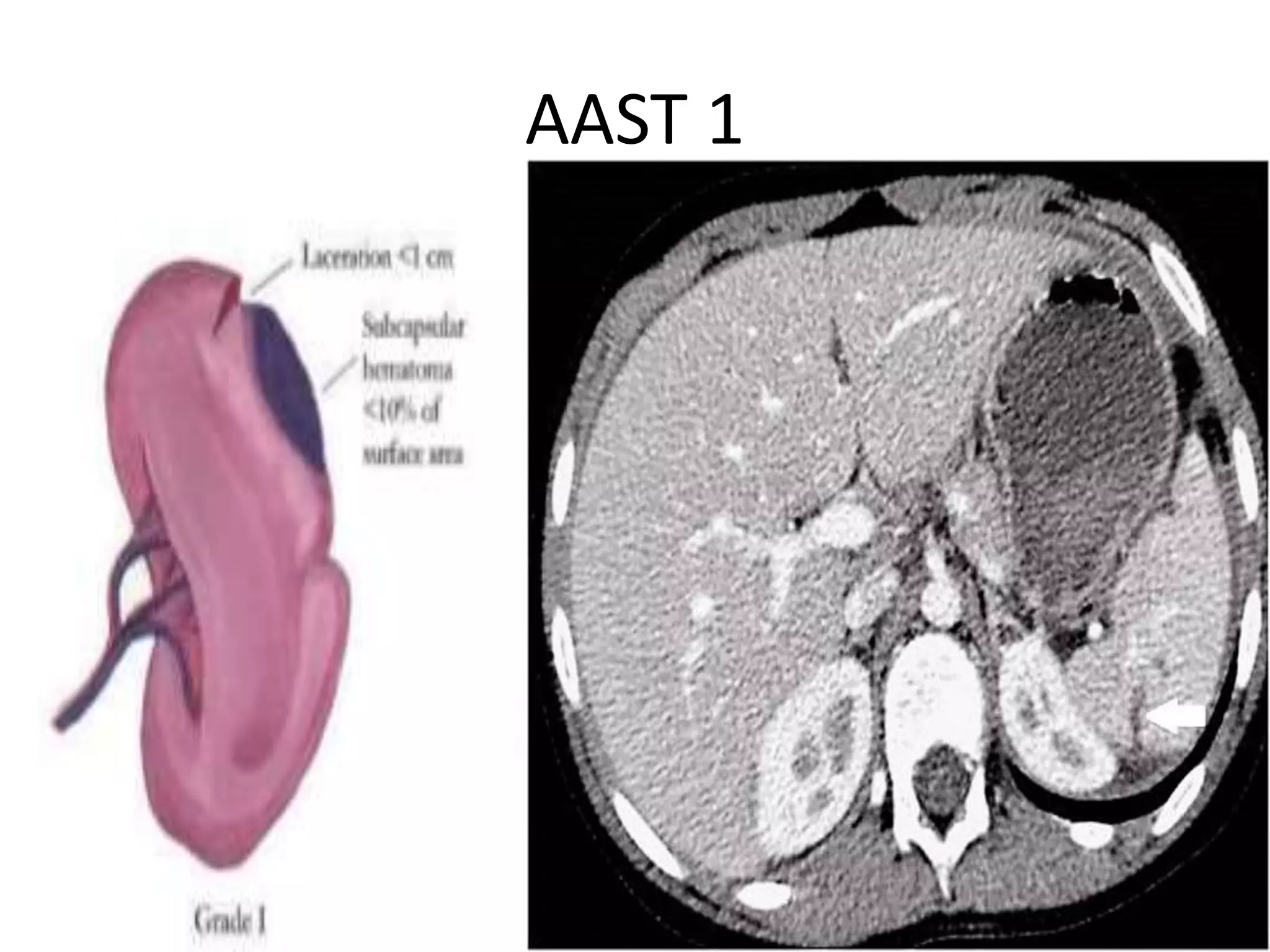 Splenic injuries ppt by manjusb | PPTX