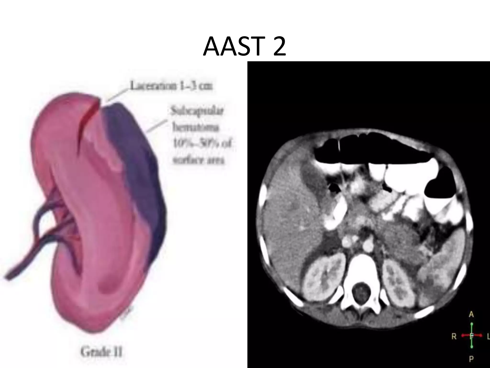 Splenic injuries ppt by manjusb | PPTX