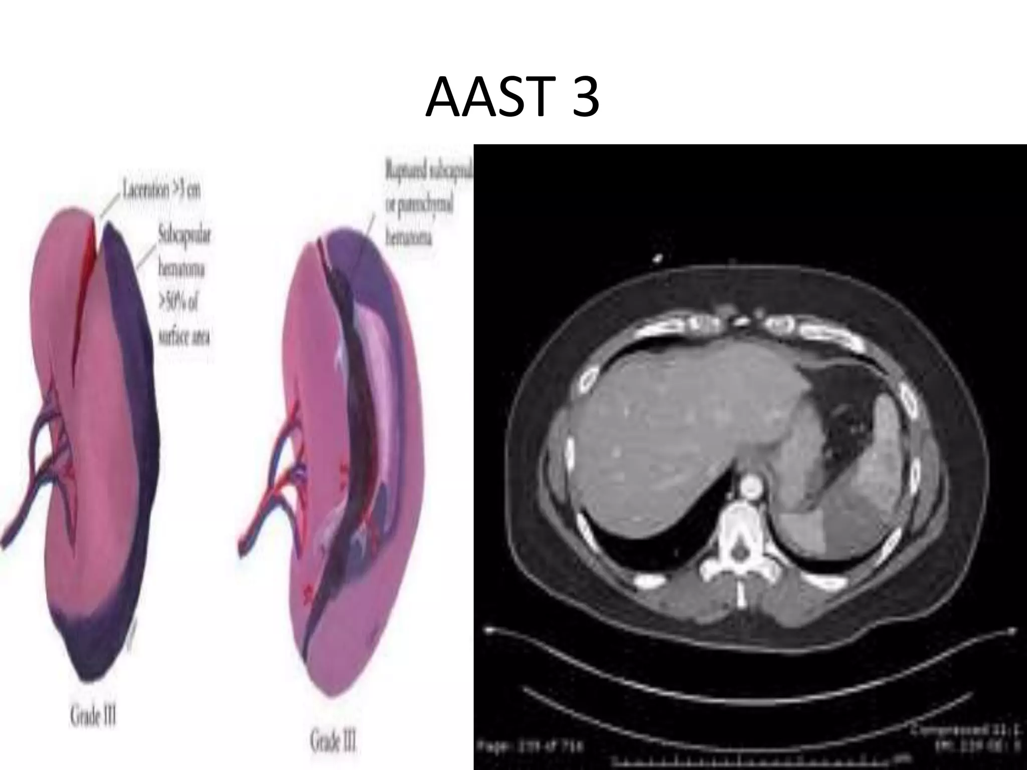 Splenic injuries ppt by manjusb | PPTX