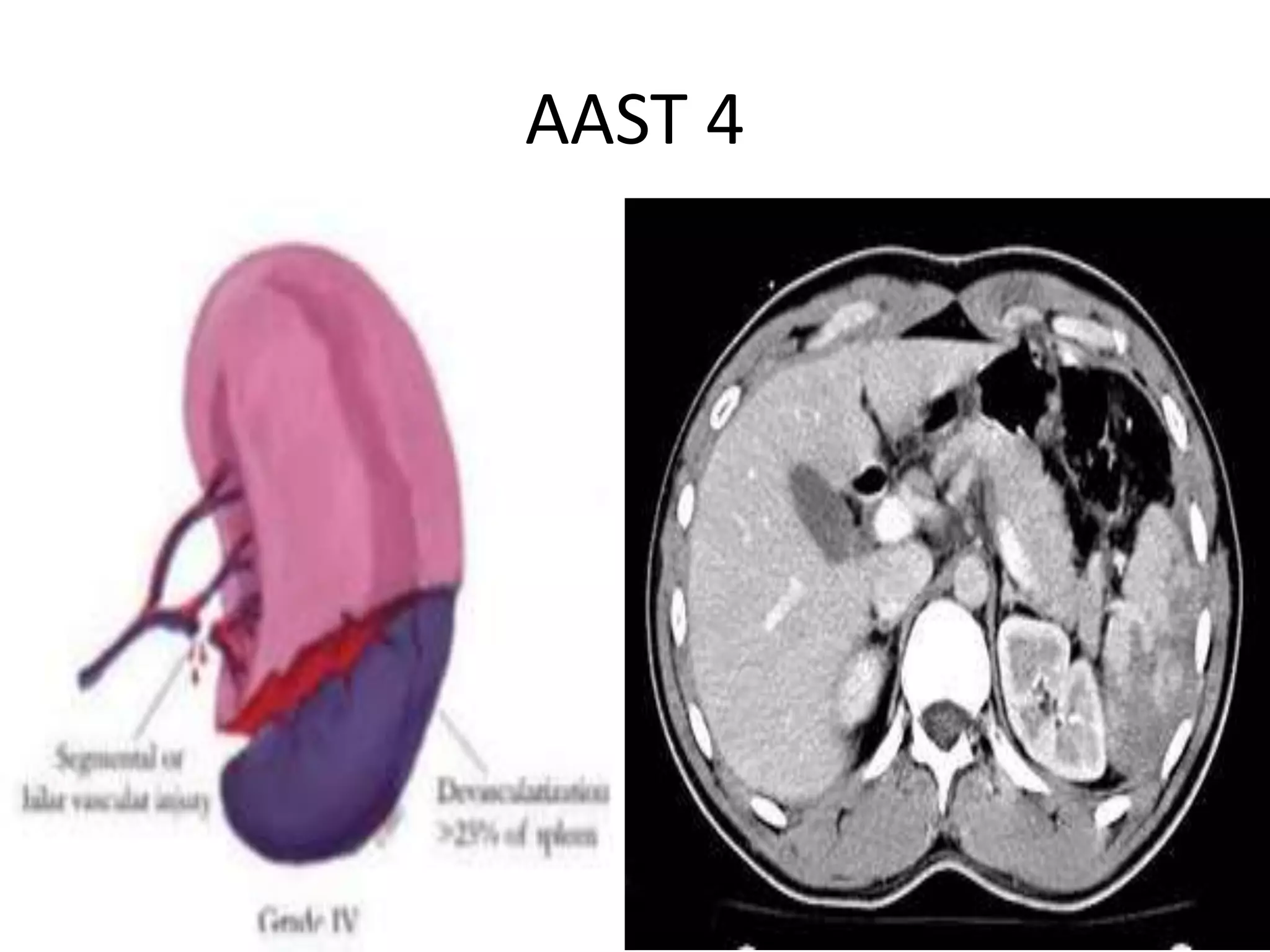 Splenic injuries ppt by manjusb | PPTX